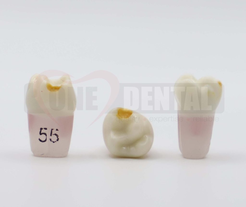 Pulpotomy Tooth 55 Prep & Stain + Screw for 1974 Paedo Model - One Dental