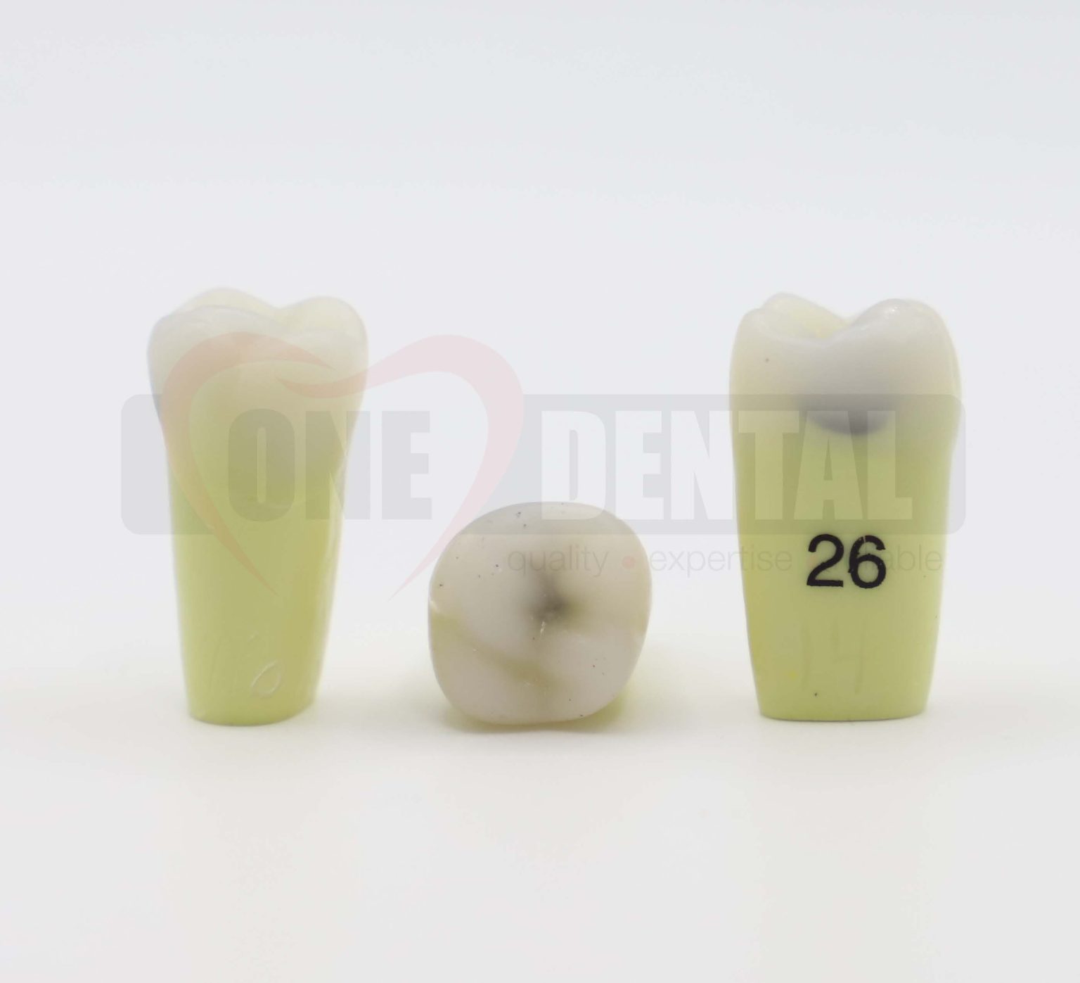 Caries Tooth 26MO Large for 2008 Adult Model - One Dental