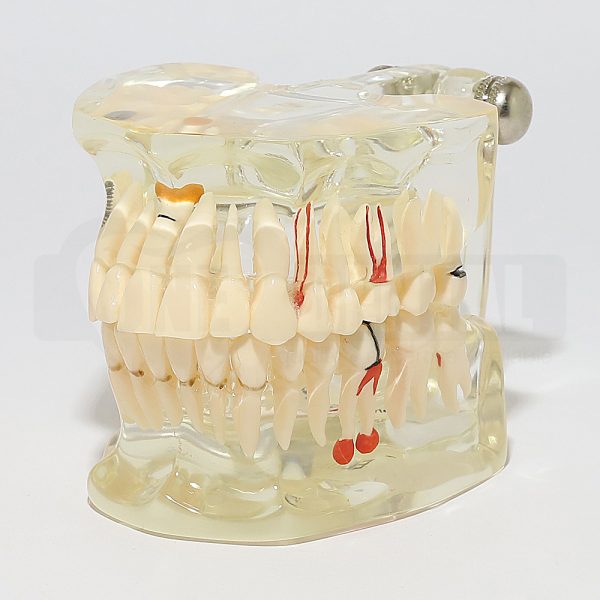 Solid Transparent Adult Pathology Model with Implant and edentulous ...