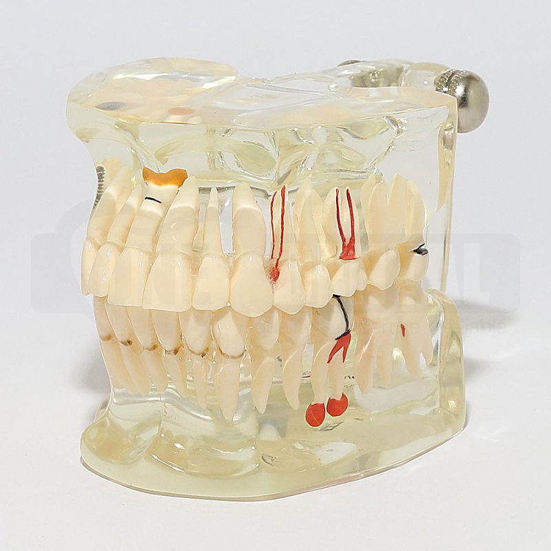 Solid Transparent Adult Pathology Model with Implant and edentulous ...